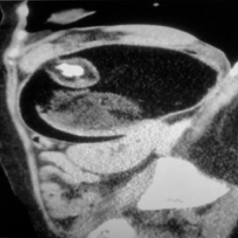 Teratoma de glándula suprarrenal - Revista Síntesis