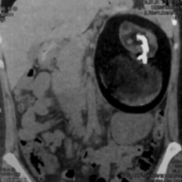 Teratoma de glándula suprarrenal - Revista Síntesis