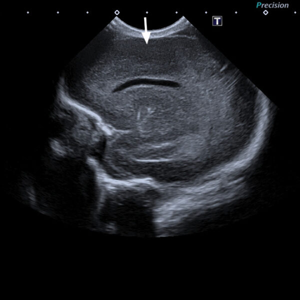 Incremento de la ecogenicidad medular renal en neonatos - Revista Síntesis