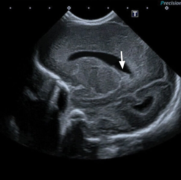 Incremento de la ecogenicidad medular renal en neonatos - Revista Síntesis