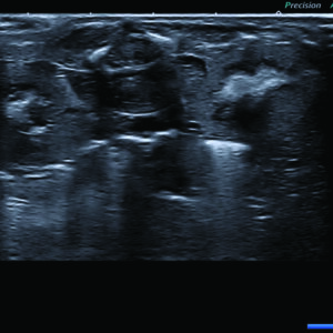 Incremento de la ecogenicidad medular renal en neonatos - Revista Síntesis