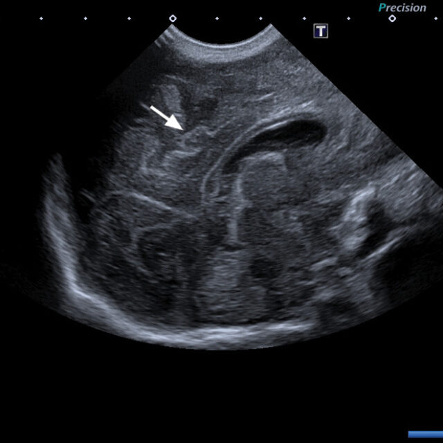 Incremento de la ecogenicidad medular renal en neonatos - Revista Síntesis