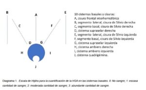Localización de aneurisma cerebral según el patrón de hemorragia ...