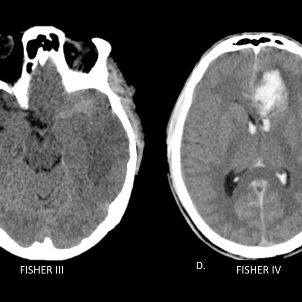 Localización de aneurisma cerebral según el patrón de hemorragia ...