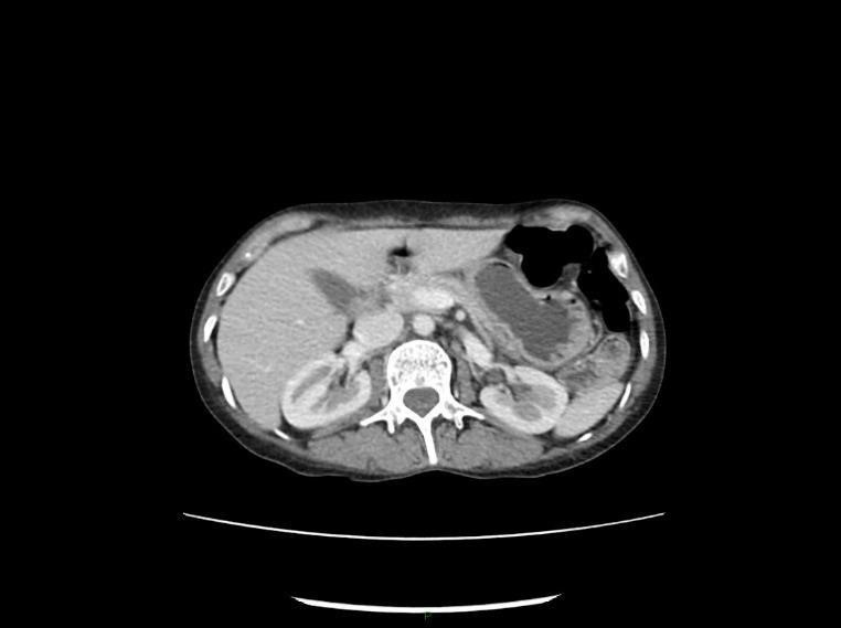 Utilidad de la tomografía computada (TC) en el diagnóstico de ...
