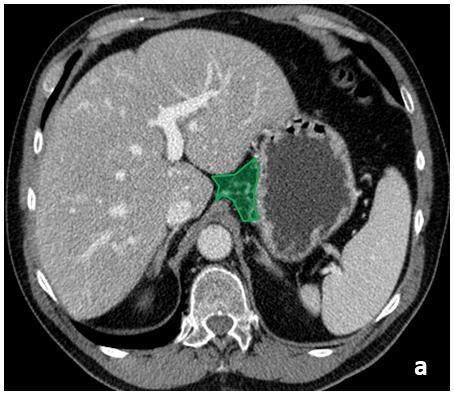Utilidad de la tomografía computada (TC) en el diagnóstico de ...