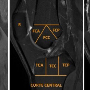 Patrones de edema óseo traumático en la rodilla y su correlación con ...