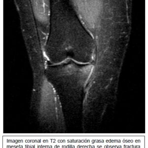 Patrones de edema óseo traumático en la rodilla y su correlación con lesiones de partes blandas ...