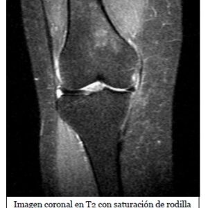 Patrones de edema óseo traumático en la rodilla y su correlación con ...