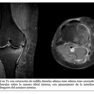 Patrones de edema óseo traumático en la rodilla y su correlación con ...
