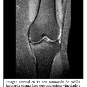 Patrones de edema óseo traumático en la rodilla y su correlación con ...
